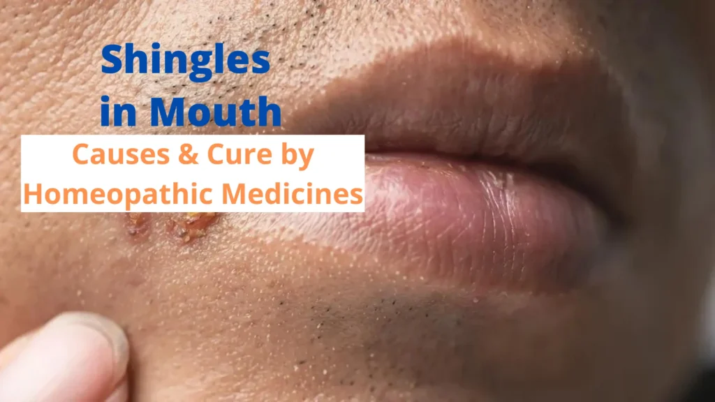 Shingles in Mouth– Symptoms, Causes & Homeopathic Medicines