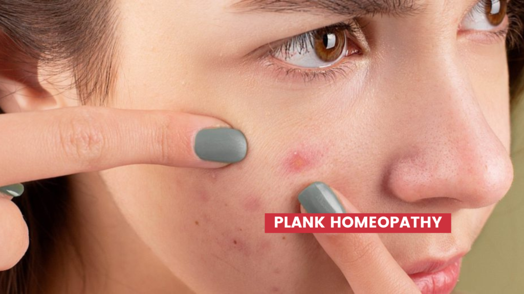 Top 10 Homeopathic Medicine For Pimples