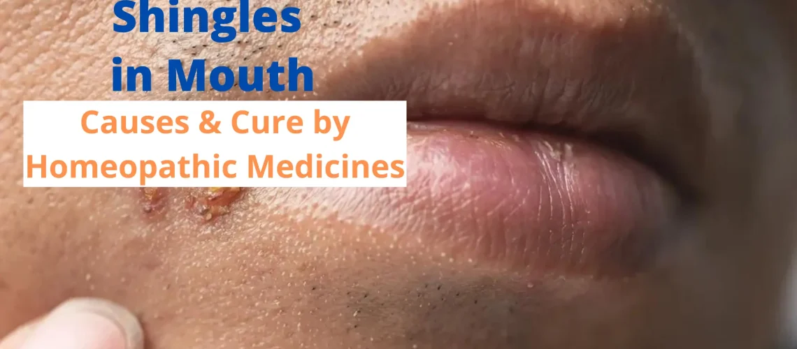 Shingles in Mouth– Symptoms, Causes & Homeopathic Medicines